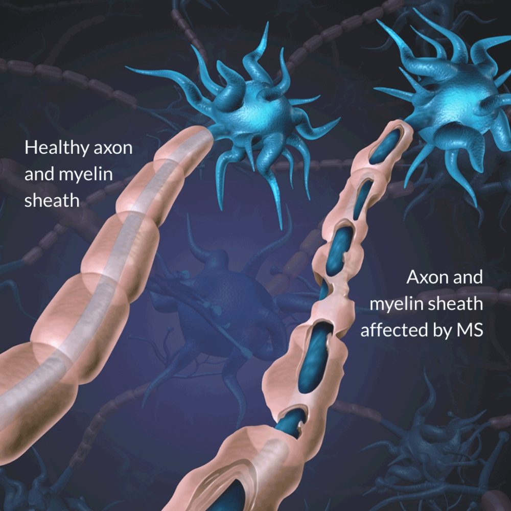 BodySmart Health + | Multiple Sclerosis and the Benefits of Physical ...